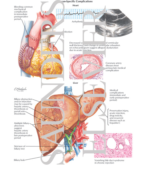 Organ-Specific Complications