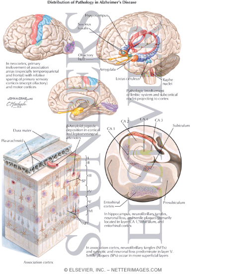 Distribution of Pathology in Alzheimer's Disease