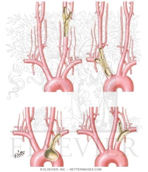 Common Sites of Obstruction