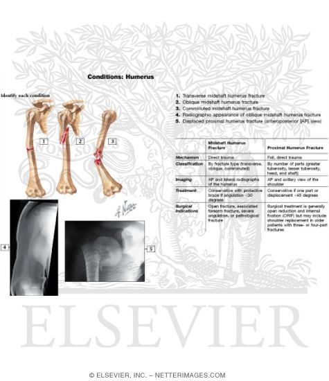 Fracture of Shaft of Humerus