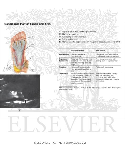 Plantar Fasciitis