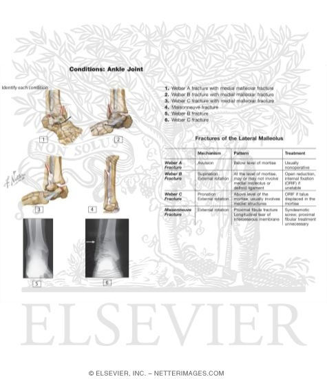 Rotational Fracture of Ankle Mortise