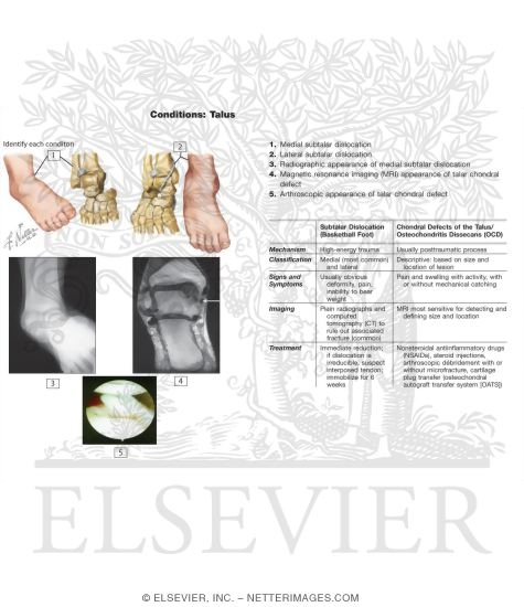 Dislocation of Subtalar Joint and Talus