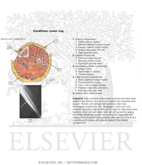 Incisions for Compartment Syndrome of Leg
