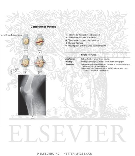 Fracture of the Patella