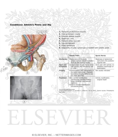 Inguinal Hernia Anatomy Netter Obsructed Left Inguinal Hernia In 60 Y