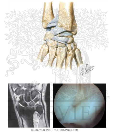 Ligaments of the Wrist