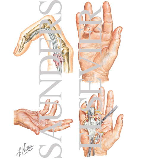 Tendons of the Fingers