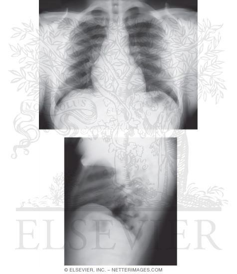 Radiographic Anatomy of the Thorax