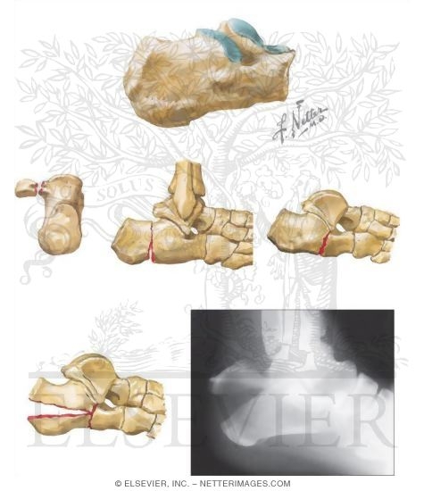 Calcaneus