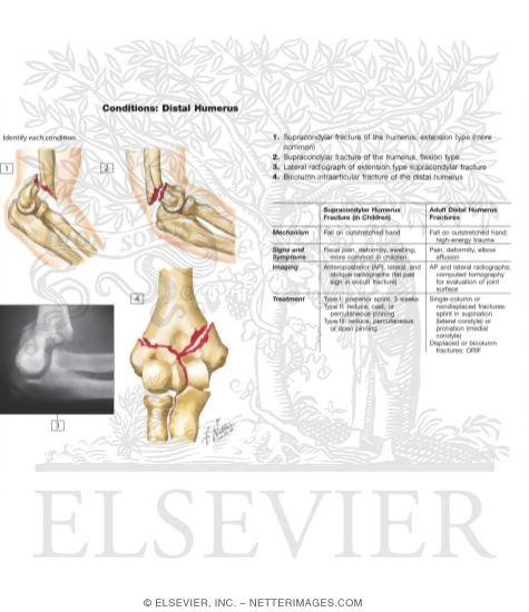 Conditions: Distal Humerus