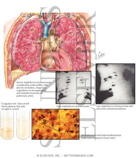 Staphylococcal Pneumonia