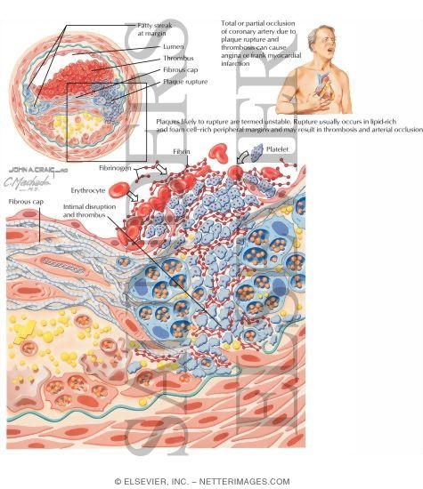 Atherogenesis: Unstable Plaque Formation