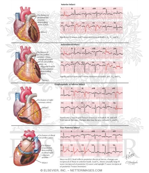 Localization of Myocardial Infarcts