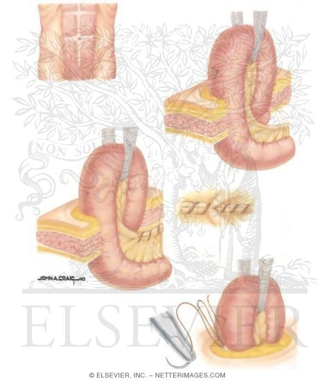 Types Of Stomas Loop And Ileostomy Technique