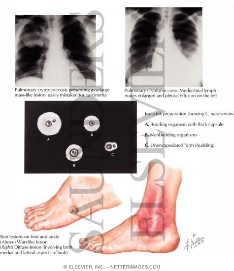 Cryptococcosis (Torulosis)