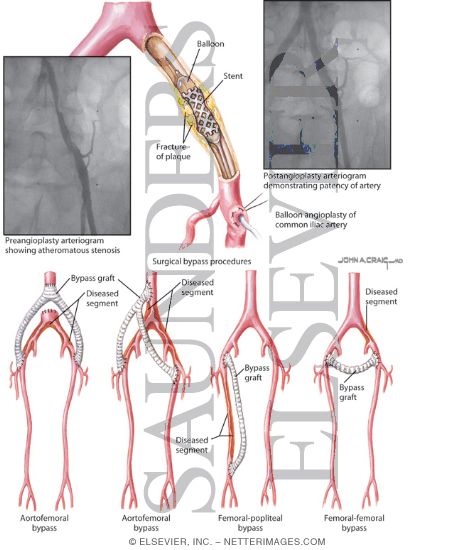 Percutaneous Peripheral Angioplasty