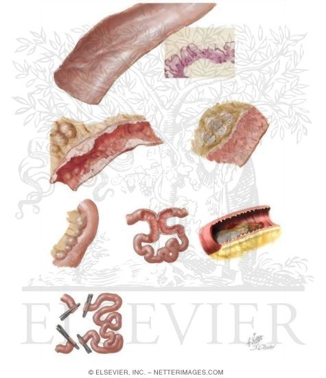 Malabsorption Syndrome: Small Intestinal Causes