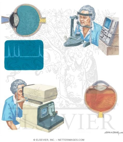 Intraocular Lens (IOL) Studies