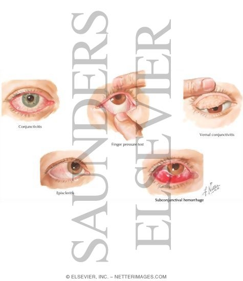 Eyelid Infection and Conjunctival Disorders