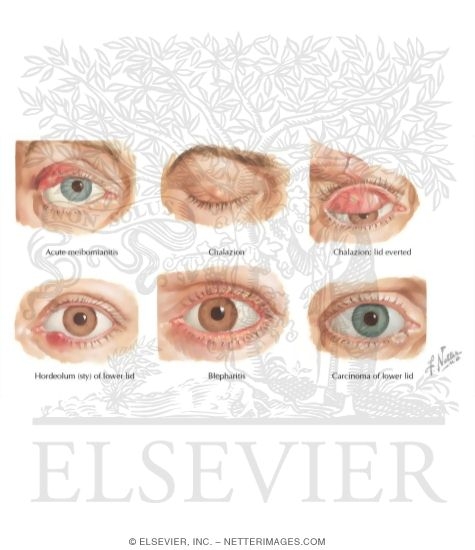 Eyelid Infection and Conjunctival Disorders