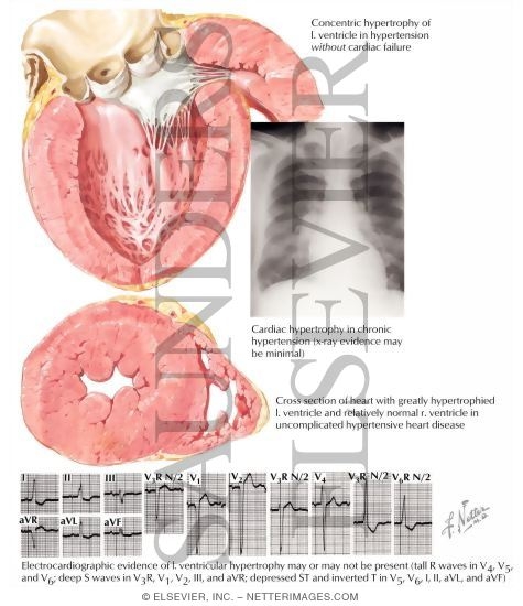 Heart Disease in Hypertension