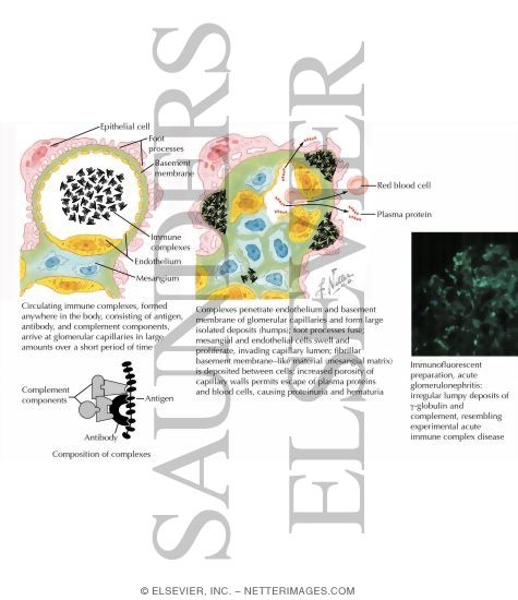 Hypothesis of Pathogenesis of Acute Glomerular Injury By Circulating ...