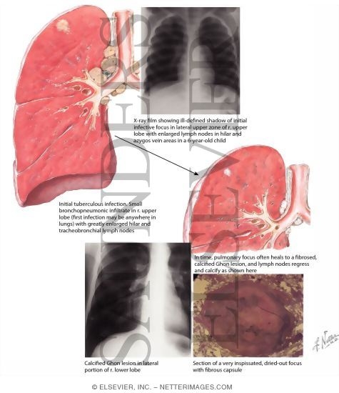 Initial (Primary) Tuberculous Complex