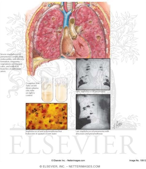 Staphylococcal Pneumonia