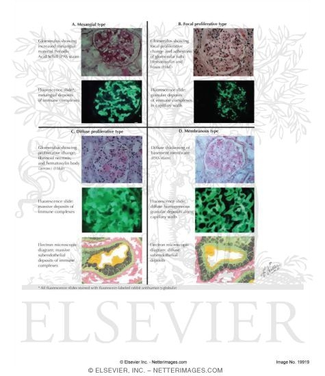 Renal Lesions in Systemic Lupus Erythematosus (SLE)