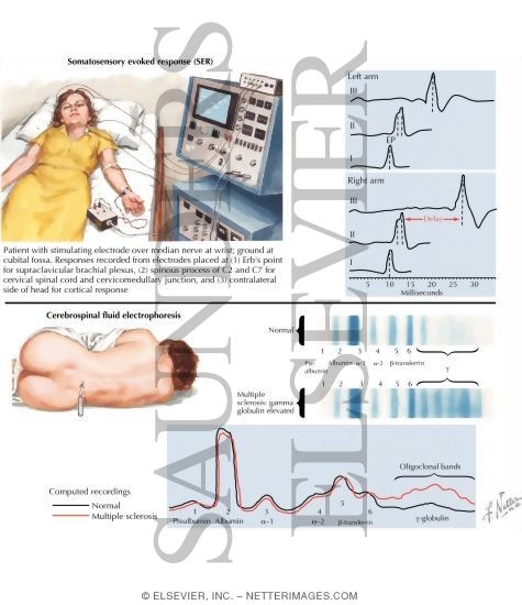 Multiple Sclerosis: Diagnostic Tests Multiple Sclerosis: Diagnostic Tests