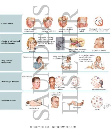 Uncommon Etiologic Mechanisms in Stroke