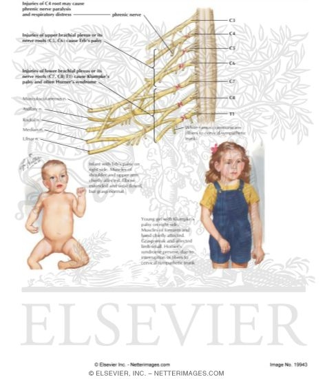 erb's palsy presentation