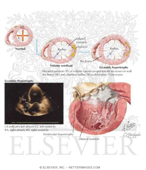 Cardiac Remodeling Secondary to Volume Overload