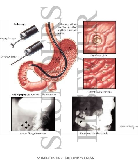 diagnostics for ulcer