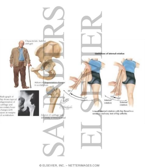 Watermarked preview of labeled image: Hip Joint Involvement In ...