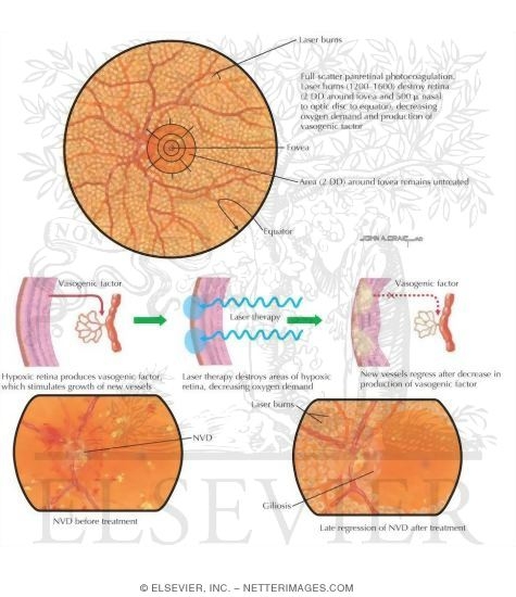 Panretinal Photocoagulation