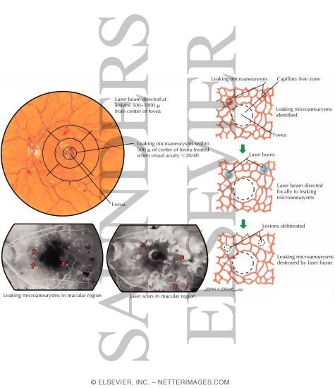 Focal Photocoagulation for Medical Edema