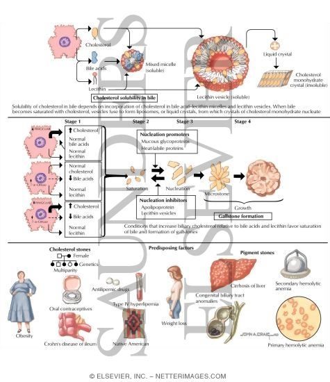 Pathogensis of Gallstones