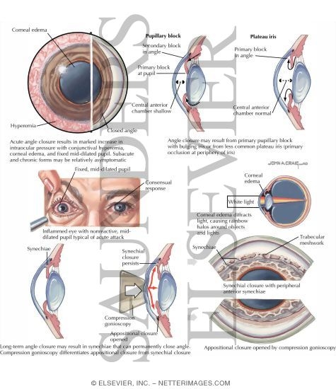 Primary Closed Angle Glaucoma