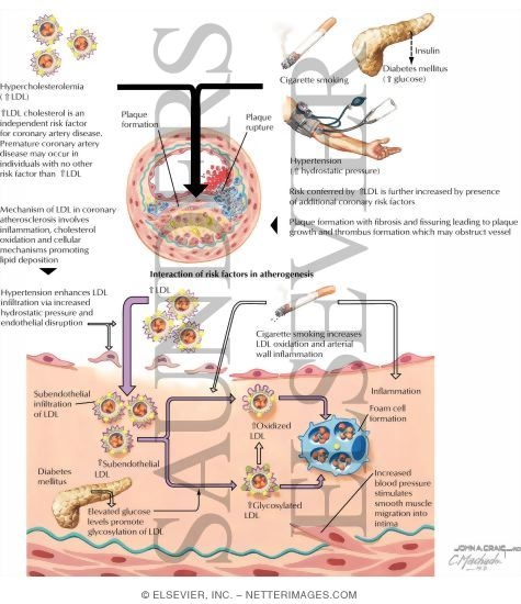 Hypercholesterolemia As Risk Factor In Coronary Artery Disease
