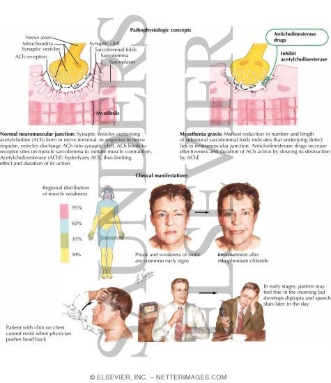 Example of Cholinergic Drug Treatment: Myasthenia Gravis