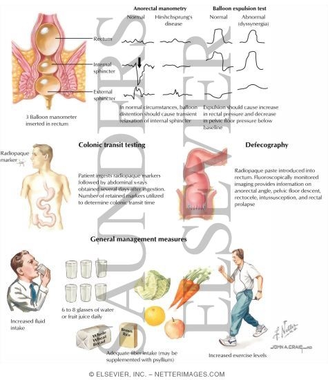 Diagnosis and Management of Constipation