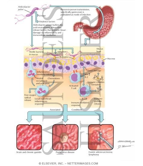 Etiology and Pathogenesis of Helicobacter Pylori Infection