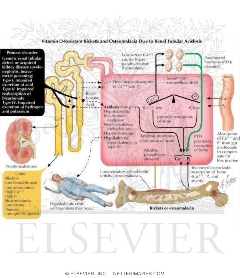 Renal Tubular Acidosis Ultrasound