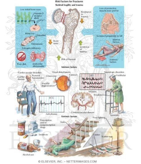 Risk Factors for Fractures