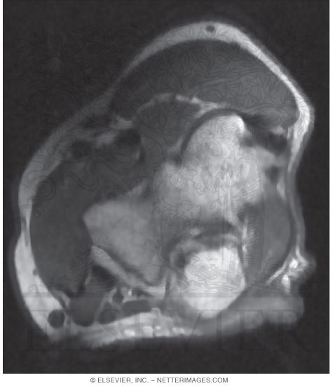 Elbow, Cubital Tunnel
