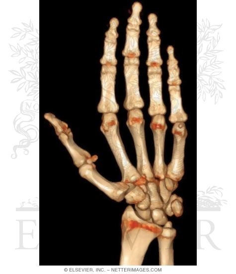 Carpal Bones