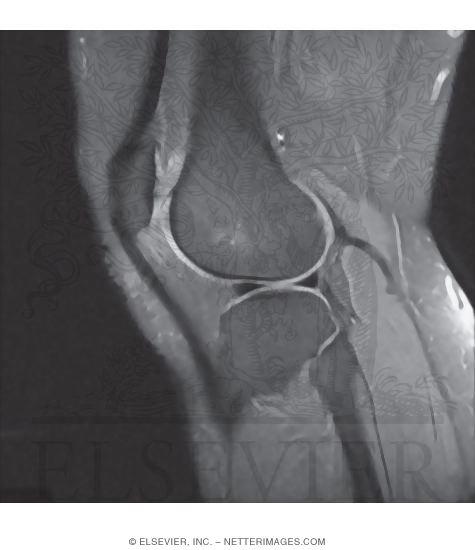 Knee Joint, Lateral View