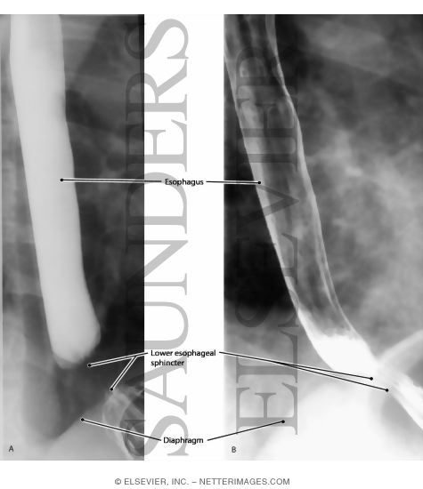 Esophagogastric Junction